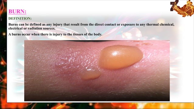 BURNS, CALCULATION OF BURNS, CALCULATION OF FLUID REQUIREMENT AND ...