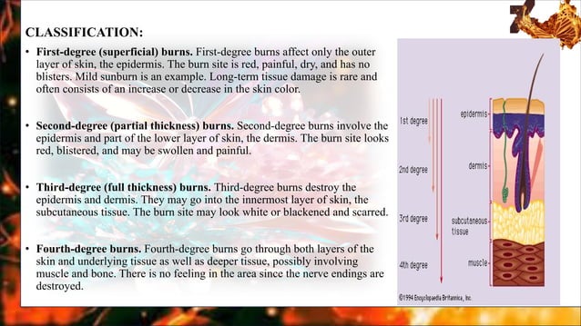 BURNS, CALCULATION OF BURNS, CALCULATION OF FLUID REQUIREMENT AND ...