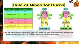 BURNS, CALCULATION OF BURNS, CALCULATION OF FLUID REQUIREMENT AND ...