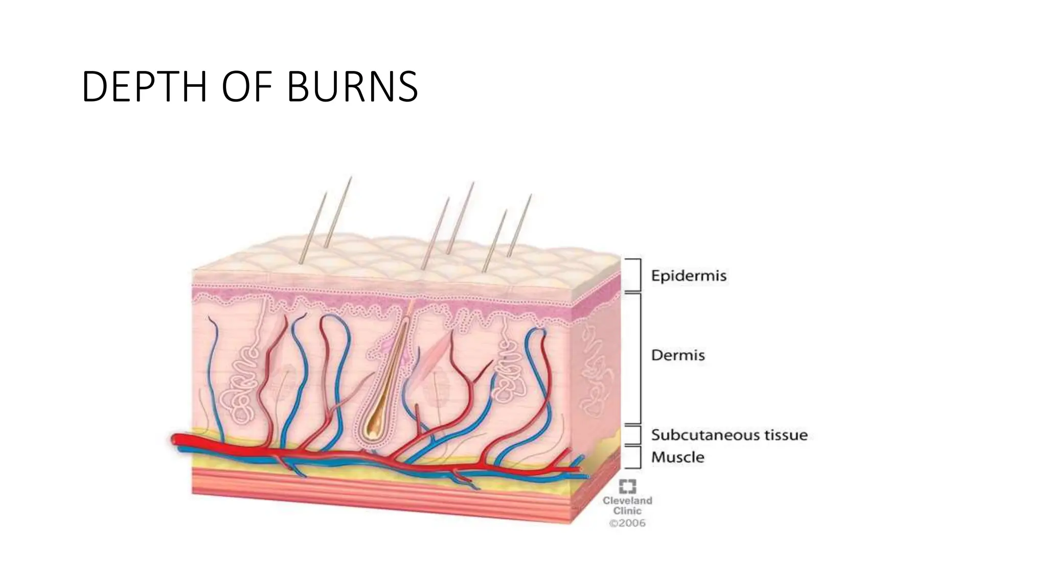 ASSESSMENT AND CLASSIFICATION OF BURNS .pptx