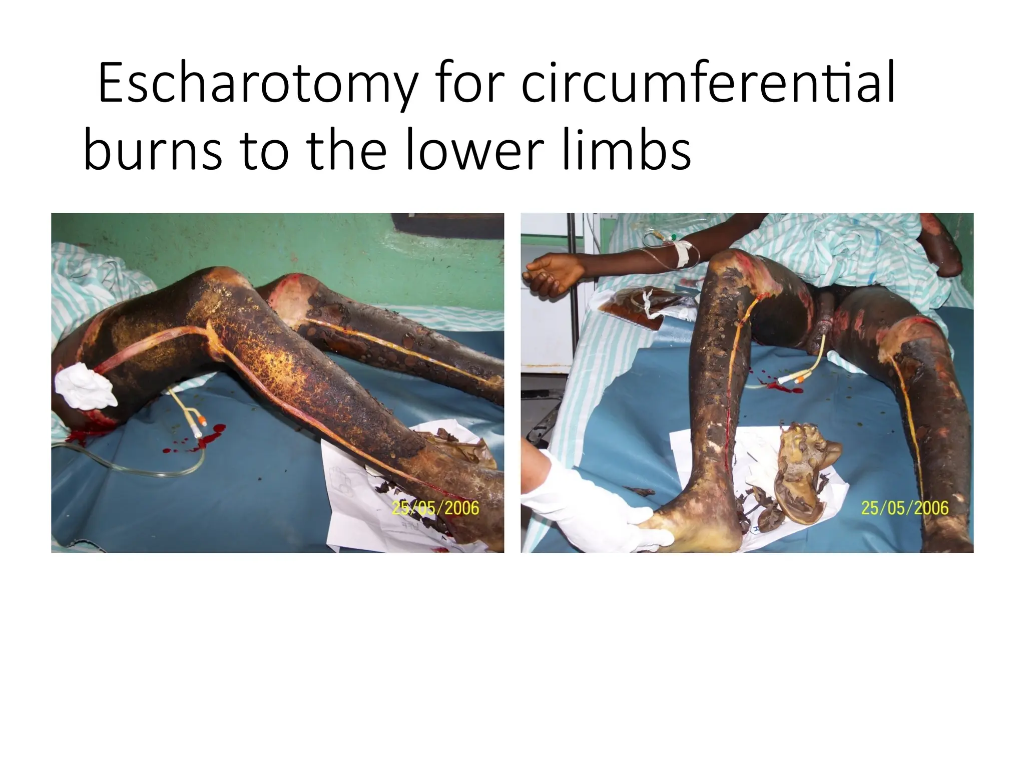 The presentation is about Burns and hazards | PPTX