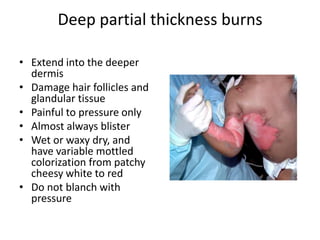 Burns power point presentation 12121.pdf