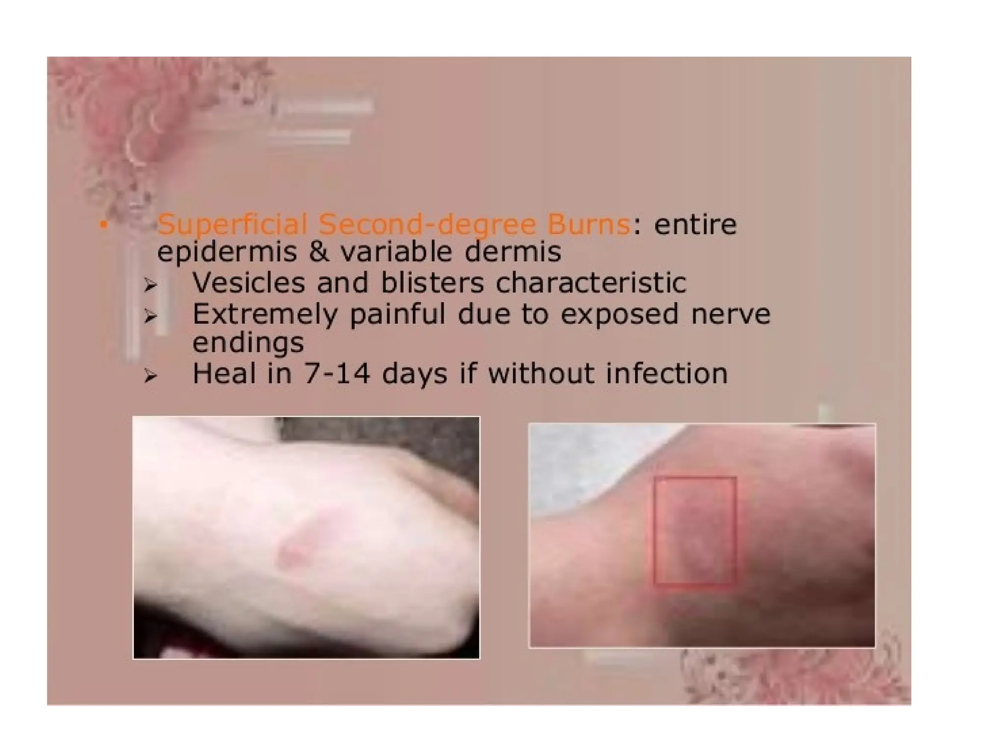 BURNS degree of burns types of burns classification of burns | PPT