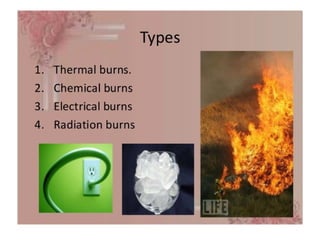BURNS degree of burns types of burns classification of burns | PPT