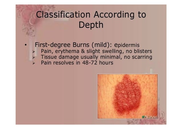 BURNS degree of burns types of burns classification of burns | PPT