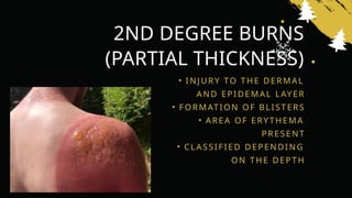 Burns Classification and Evaluation.pptx