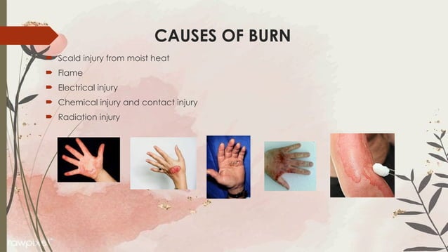 BURNS (PAEDIATRIC)CHILD HEALTH NURSING.pptx