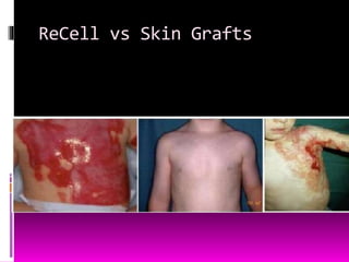 Burns - Before and After | PPTX