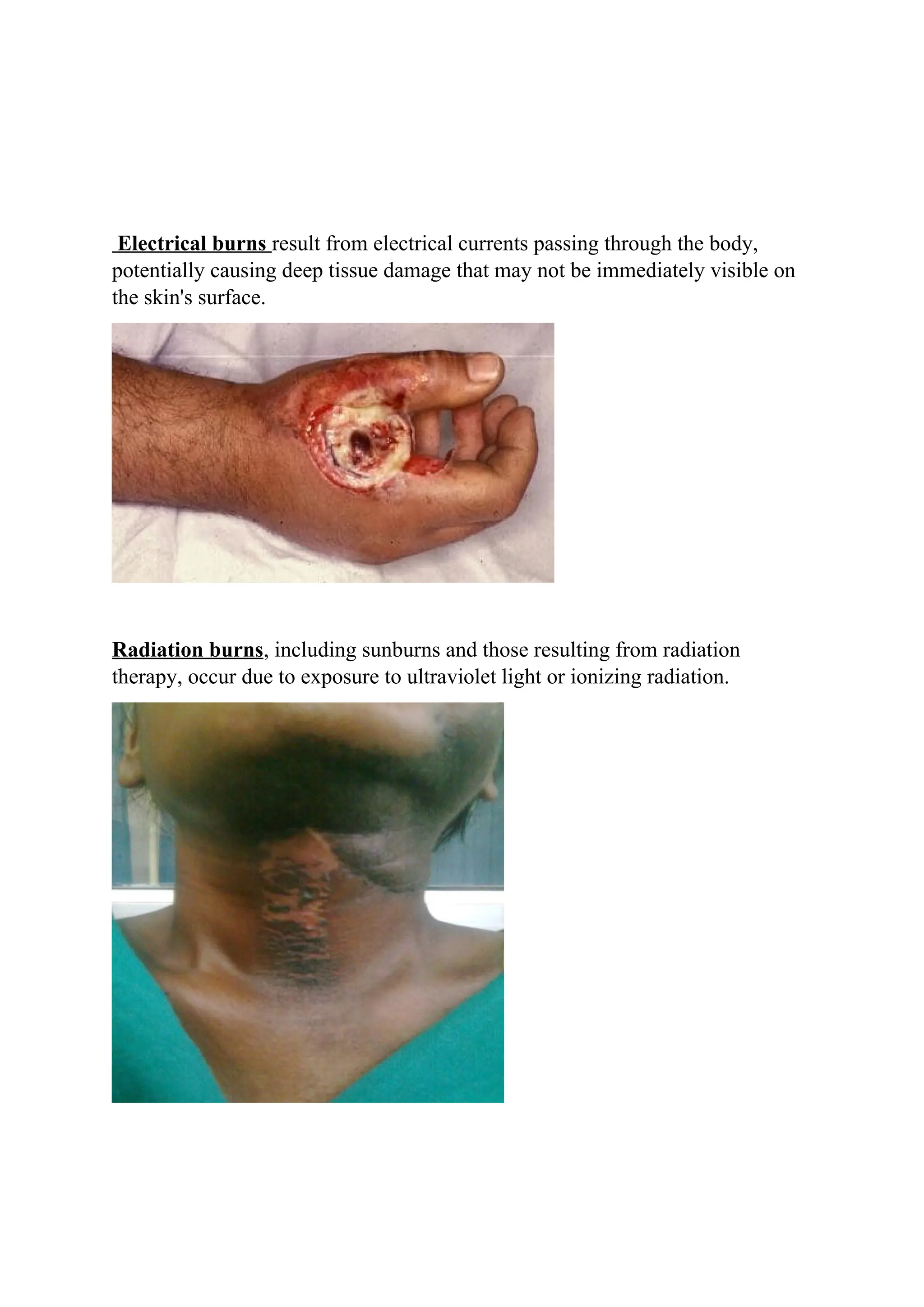 Burns -definations, types, causes, complications, degreee of burns, and ...