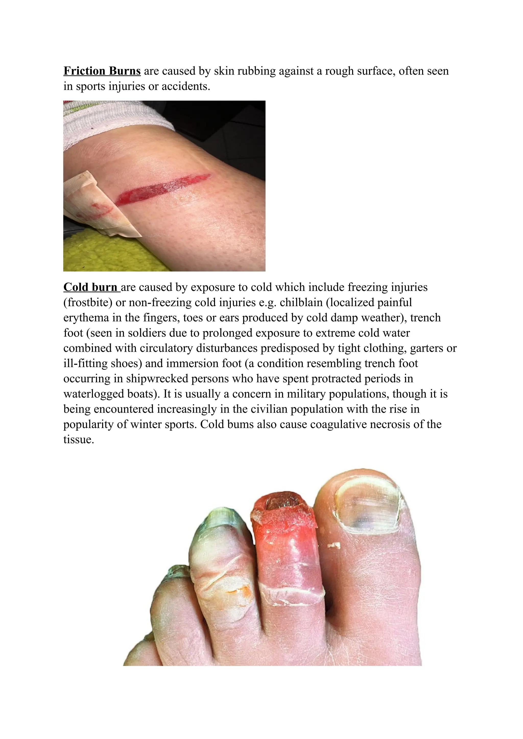 Burns -definations, types, causes, complications, degreee of burns, and ...