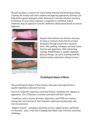 Burns -definations, types, causes, complications, degreee of burns, and ...