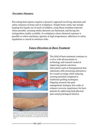 Burns -definations, types, causes, complications, degreee of burns, and ...