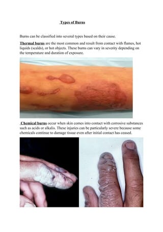 Burns -definations, types, causes, complications, degreee of burns, and ...