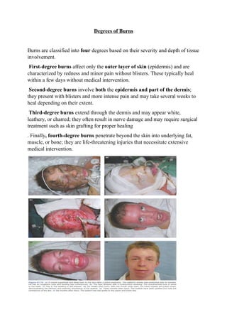 Burns -definations, types, causes, complications, degreee of burns, and ...
