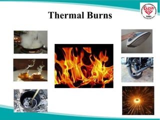 Burns-Original.pptx | First Aid | Injuries