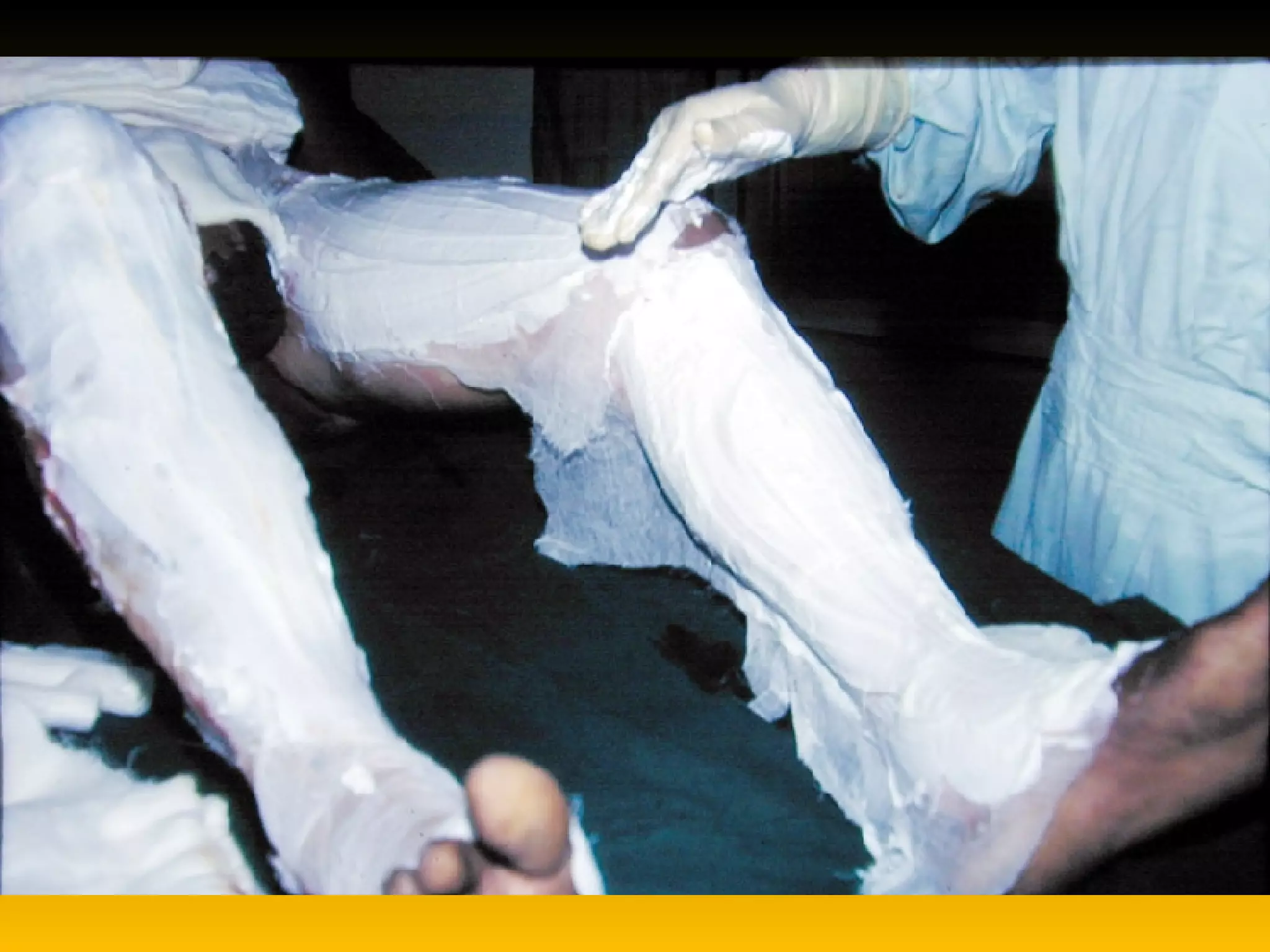 Burns (Thermal,Electrical,Lightening and Chemical Injuries) | PPT