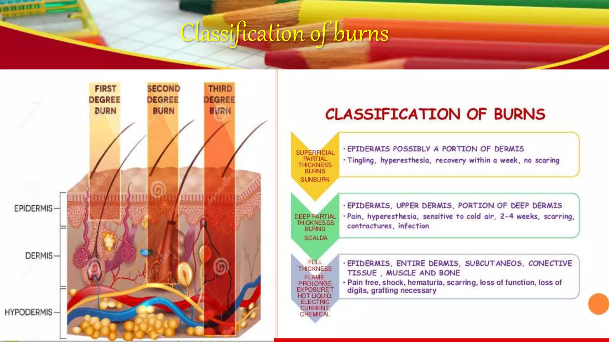 Burns presentation by 2nd yr MSc nursing student | PPTX
