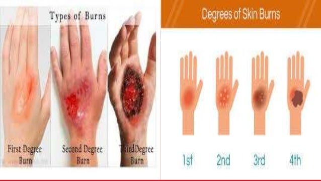 Burns presentation by 2nd yr MSc nursing student