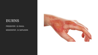 BURNS classification and management short presentation | PPTX