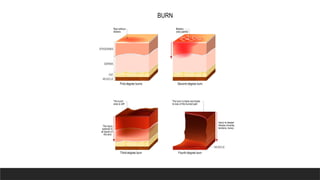 BURNS classification and management short presentation | PPTX