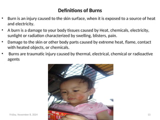BURNS note Medical and Surgical Nursing.ppt