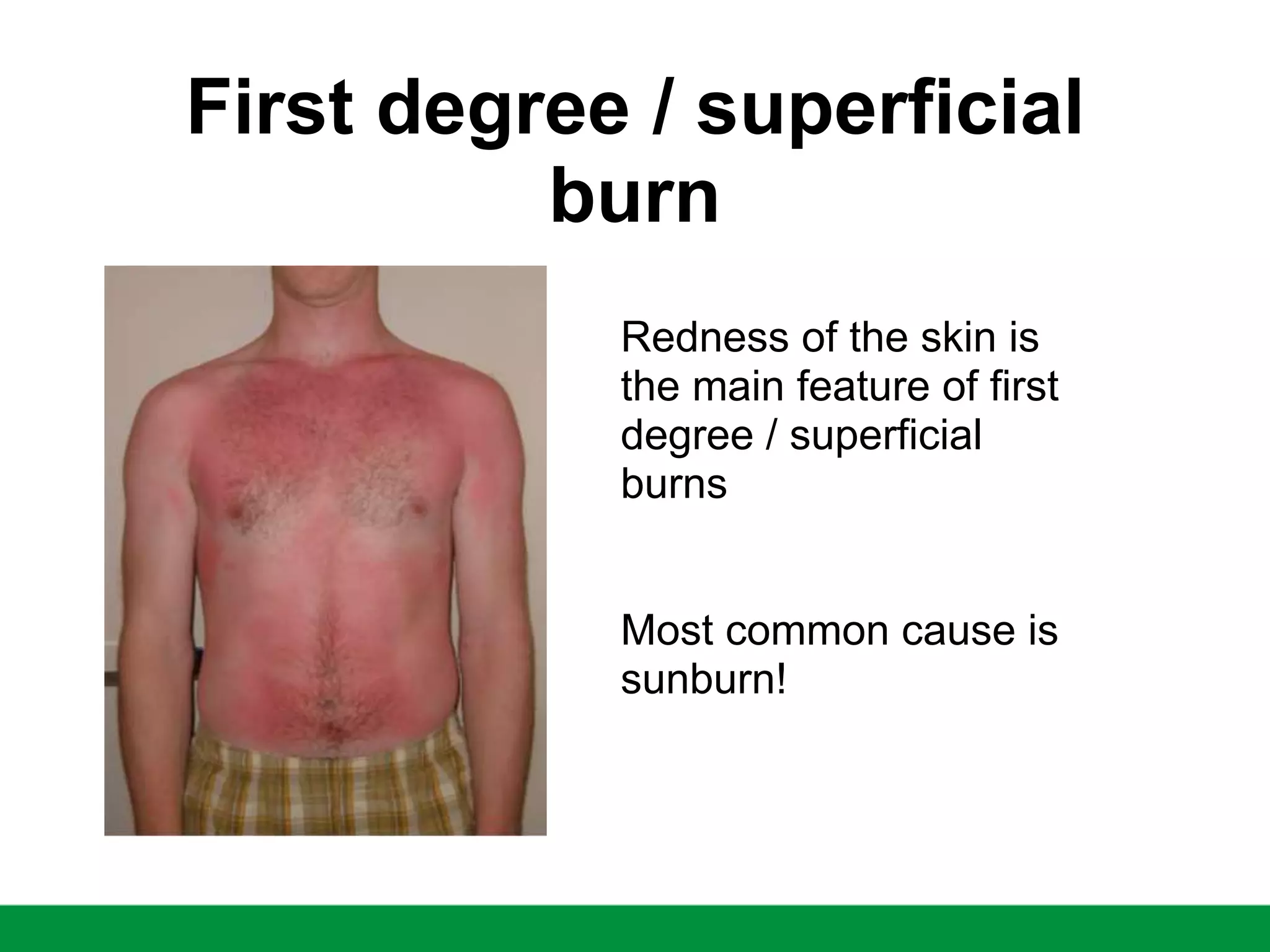 First aid in burns | PPTX