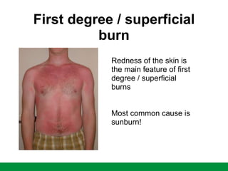 First aid in burns | PPTX