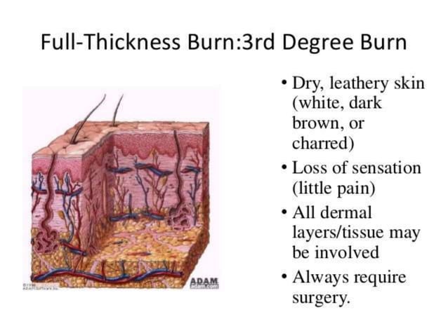 Burn | PPTX | Death, Injury, or Military Conflict | Sensitive Topics