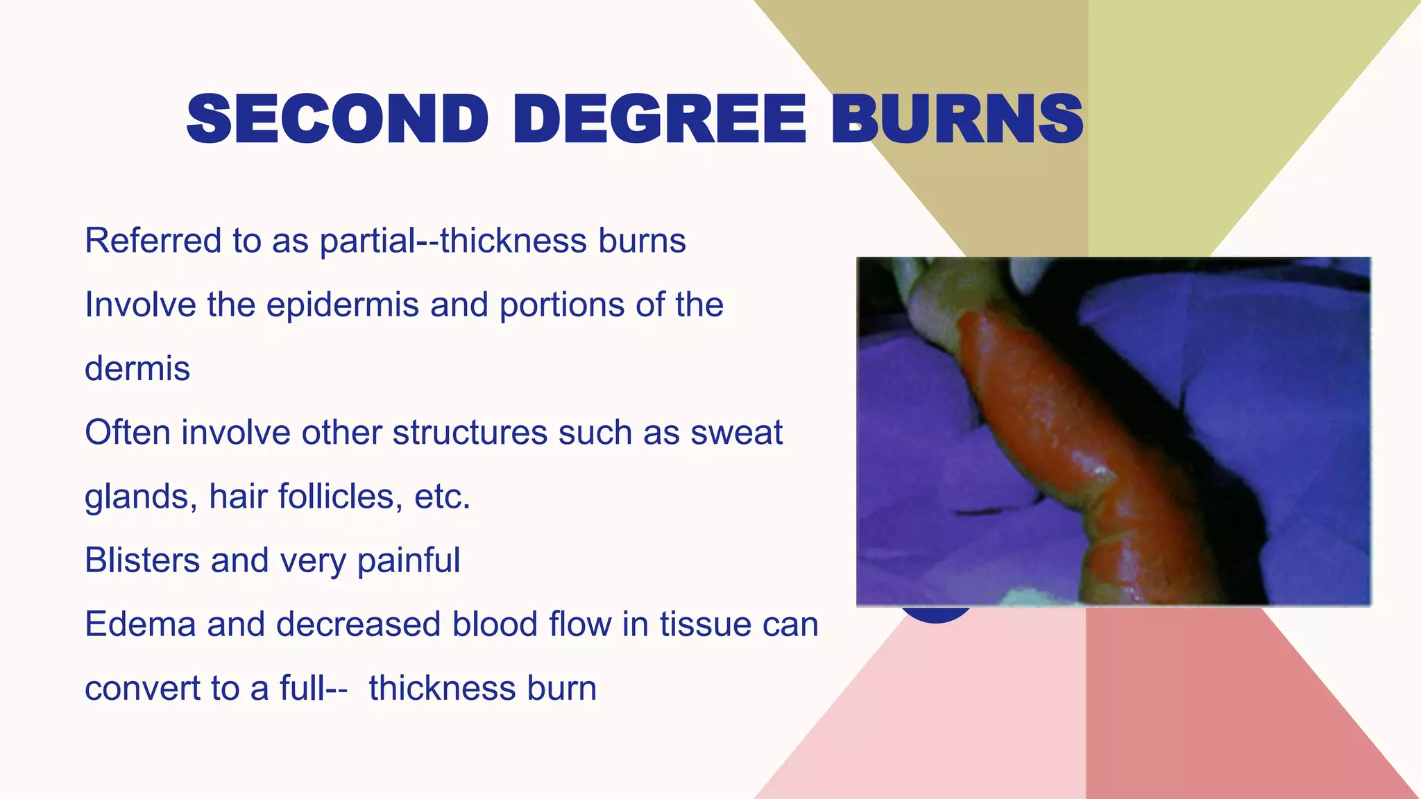 Burns and anesthesia srk.pptx