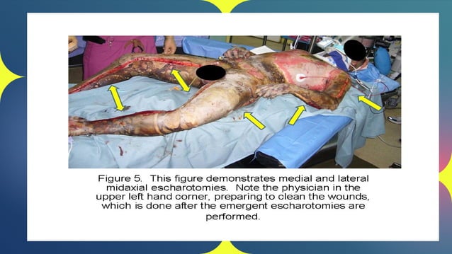 Burns and Burn Diseases how to treat burns.pptx