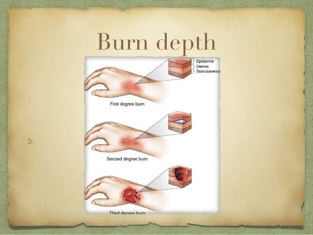 Burns -Harrison's internal medicine