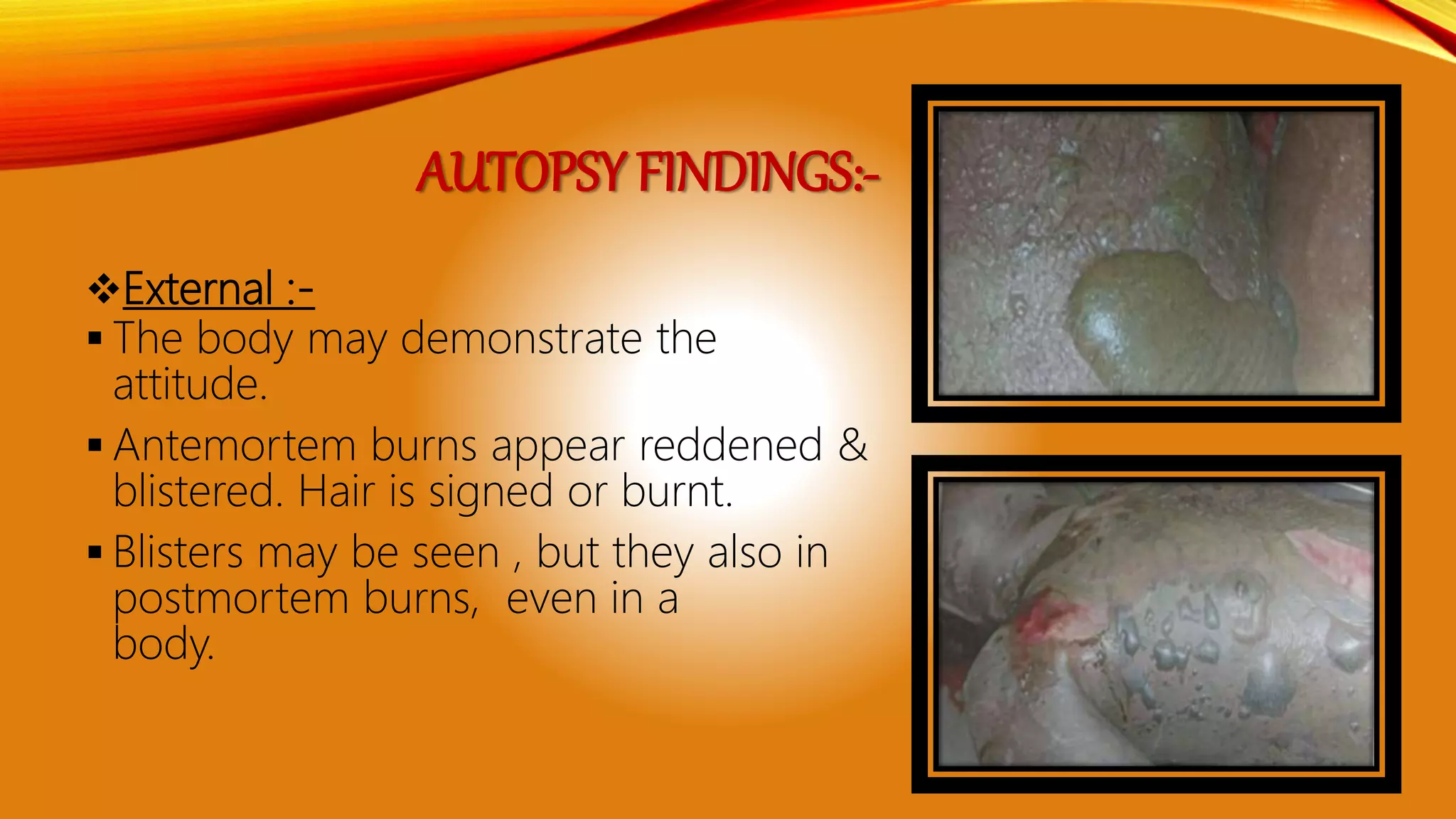 Burns by himasri reddy | PPTX