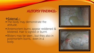 Burns by himasri reddy | PPTX