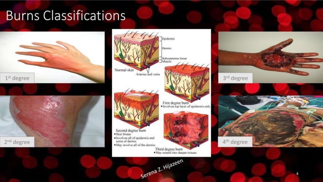Burns; Types, Management, Treatment and Causes | PPT