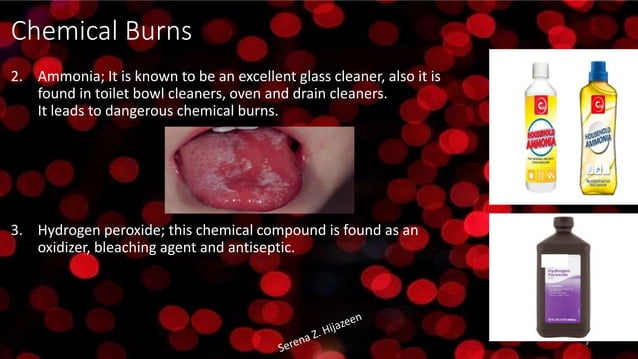 Burns; Types, Management, Treatment and Causes | PPT