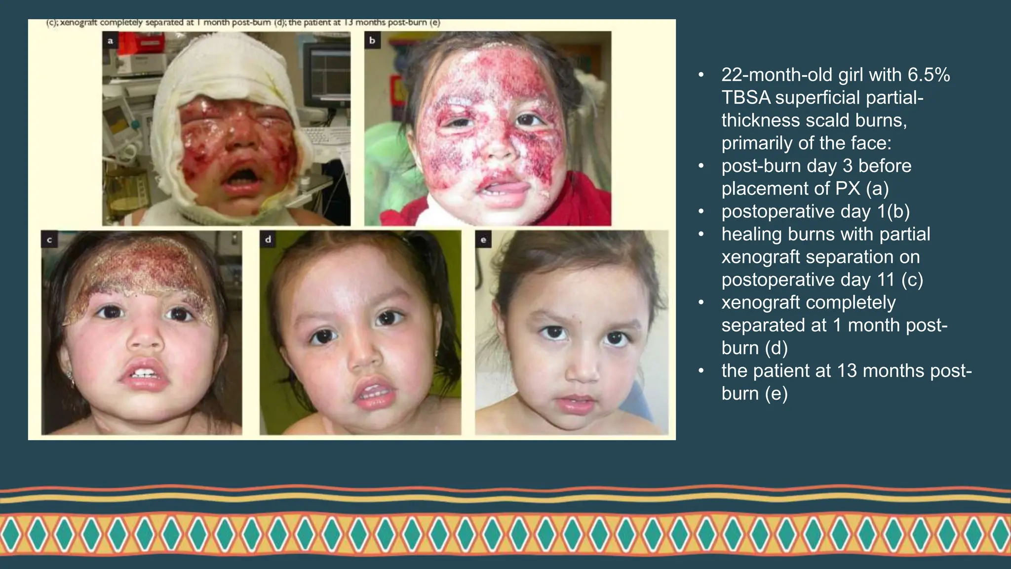 Aim of Burns Dressings and management of burns.pptx