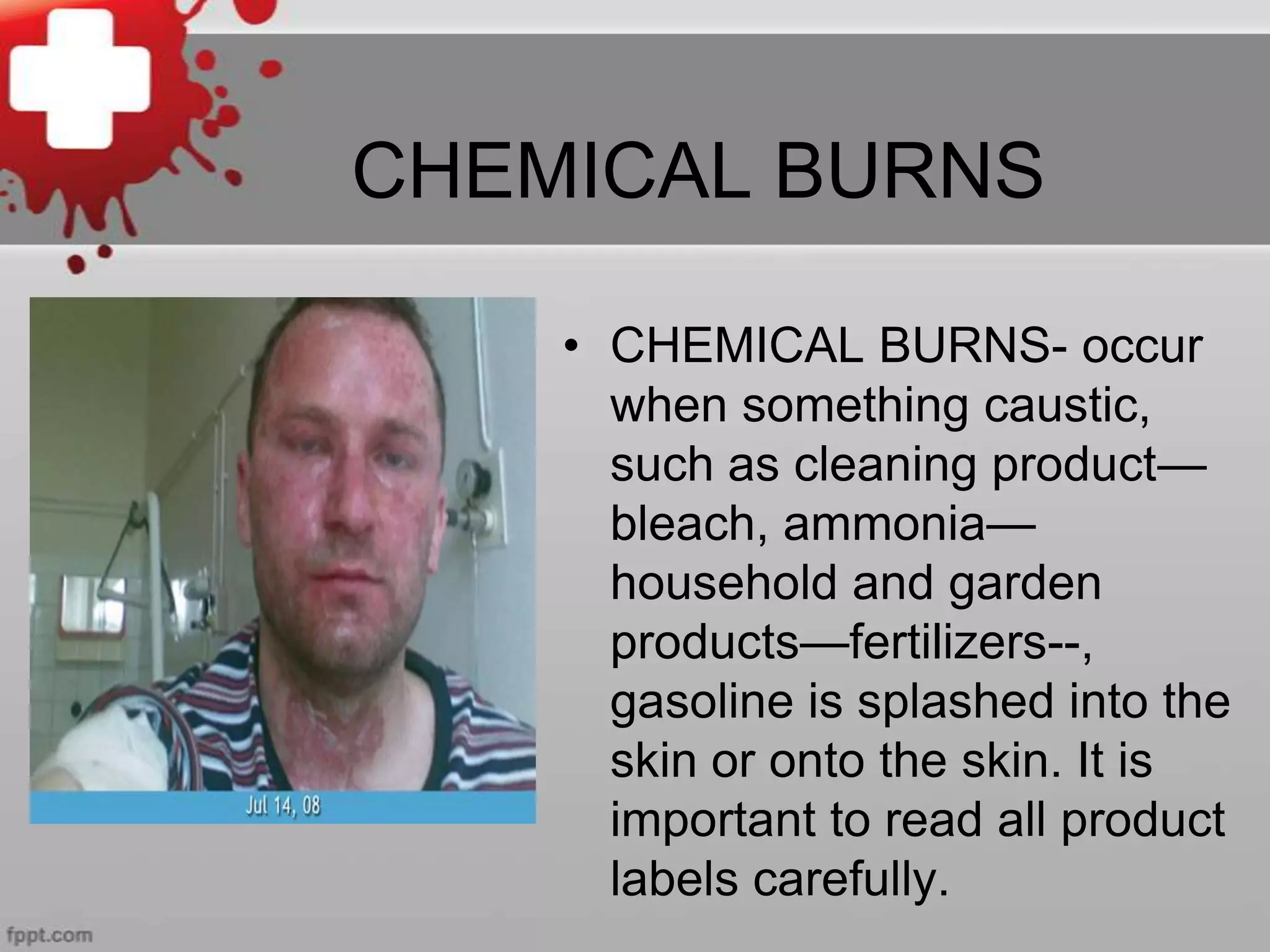 Burns first aid | PPTX