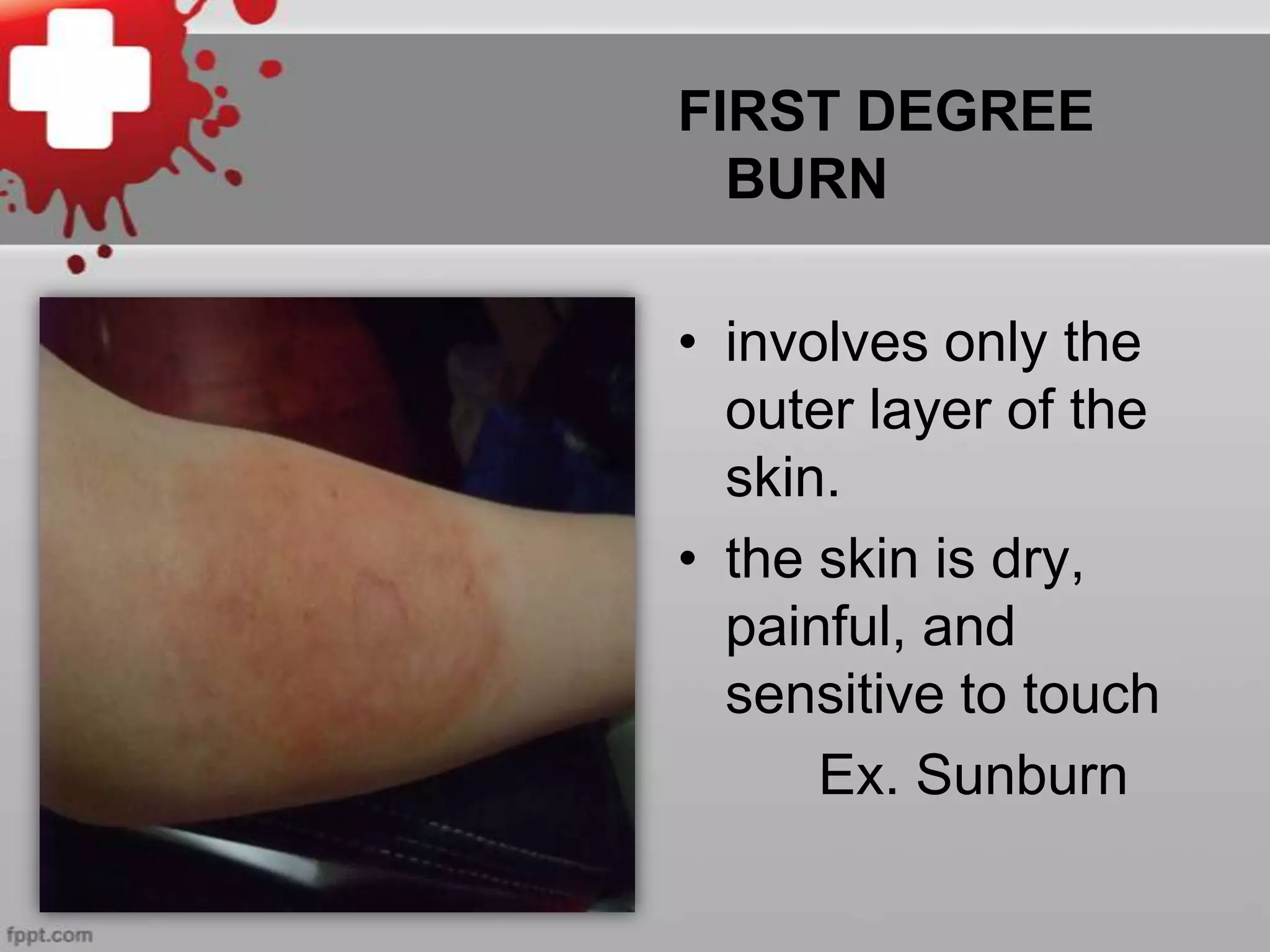 Burns first aid | PPTX