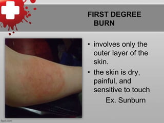 Burns first aid | PPTX
