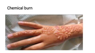 BURNS assessment and management_GRP_1_PPT[1].pptx