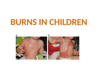 BURNS IN CHILDREN FOR 5 SEM BSC NURSING .pptx