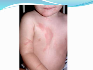 Burns in pediatrics | PPTX