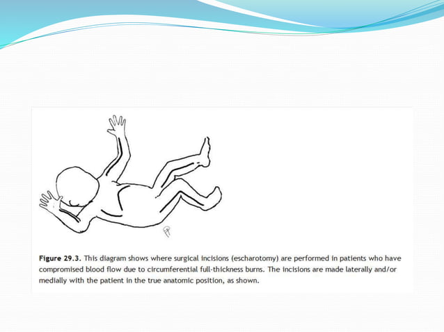 Burns in pediatrics | PPTX
