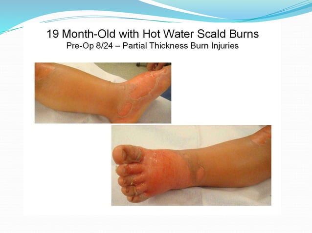 Burns in pediatrics
