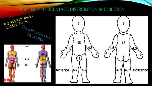 Burns in pediatrics presentation | PPTX | First Aid | Injuries