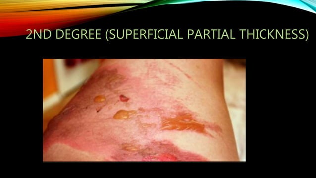 Burns in pediatrics presentation