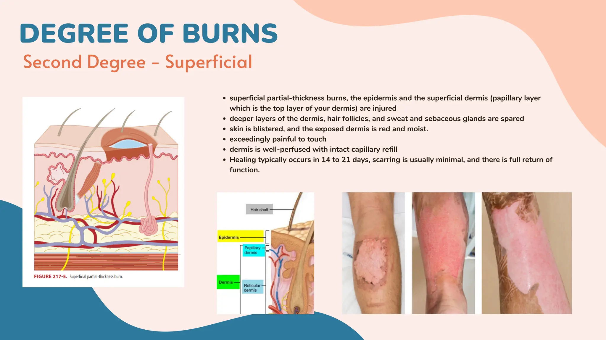 Burns (Trauma) Powerpoint - Medical School | PDF