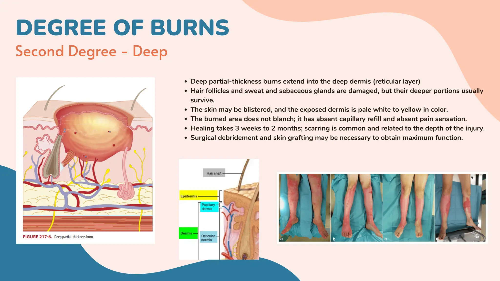 Burns (Trauma) Powerpoint - Medical School | PDF