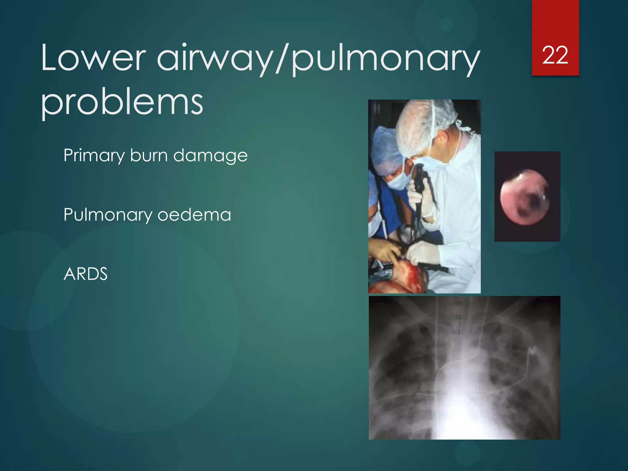 Burns management | PPTX