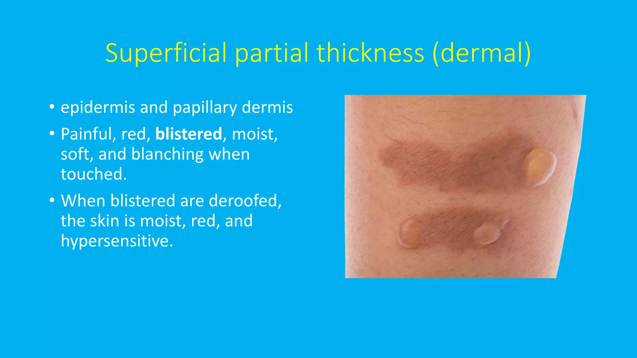 BURNS MANAGEMENT - ACUTE (1).pptx